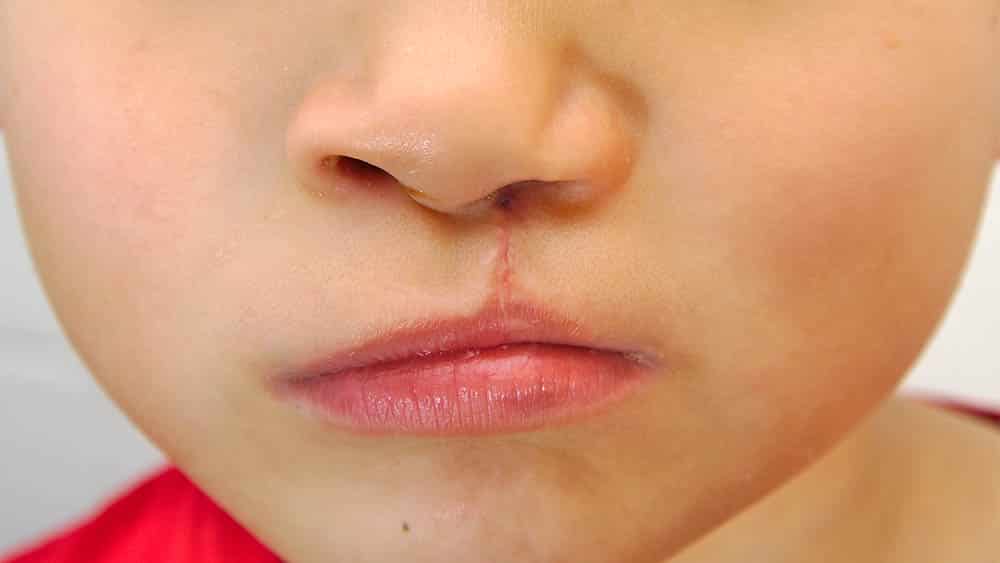 Cassems Odonto: o que é ‘lábio leporino’ e como tratar